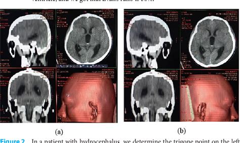 Figure 2 From Trigone Point As An Alternative Location For Ventricular Shunt Insertion