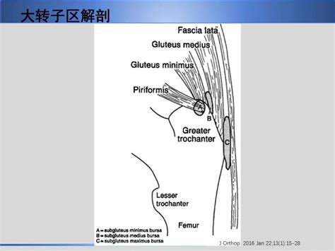 PPT股骨大转子疼痛综合征MR特征 影像PPT