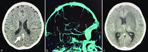 A Computed Tomography Ct Showing A Hyperdense Signal Arrow In The Download Scientific