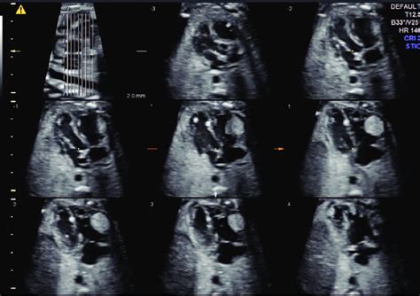 Fetal Echocardiography Spatiotemporal Image Correlation Tomographic Download Scientific