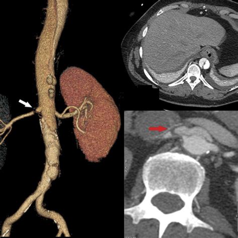 A A Three Dimensional Volume Rendering Of A Computed Tomography Ct Download Scientific