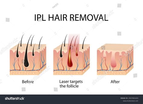 Hair Follicle Laser Examination Laser Hair Stock Vector Royalty Free