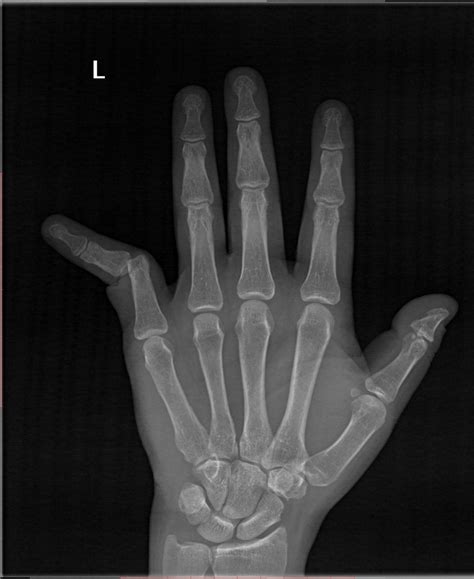 Distal Interphalangeal Joint Dislocation Treatment At Seth Obrien Blog Distal Interphalangeal Joint Dislocation Treatment At Seth Obrien Blog