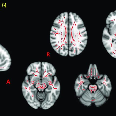Results Of Tract Based Spatial Statics Analysis Comparing Fractional Download Scientific