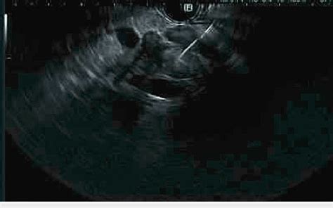 Endoscopic Ultrasonography Eus Imaging With Fine Needle Aspiration