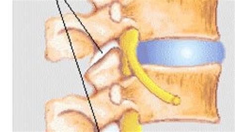 Facet Joint Fracture Lumbar At Imogen Bidwill Blog