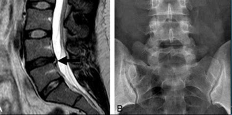 Di Imaging I Transitional Segments Spine And Pelvis Anomalies Flashcards Quizlet