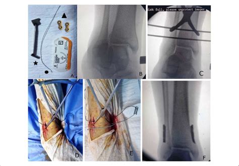 A Instrumentation For The Modified Suture Button Technique Star Download Scientific Diagram