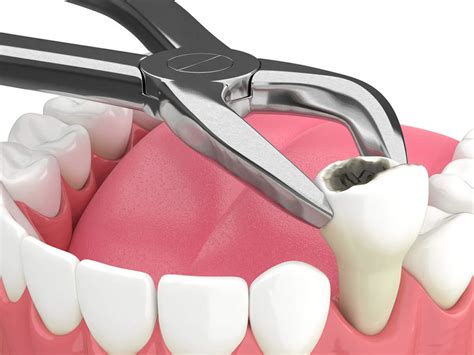 Tooth Extractions The Dentist Of Siouxland Sioux City Ia Elk