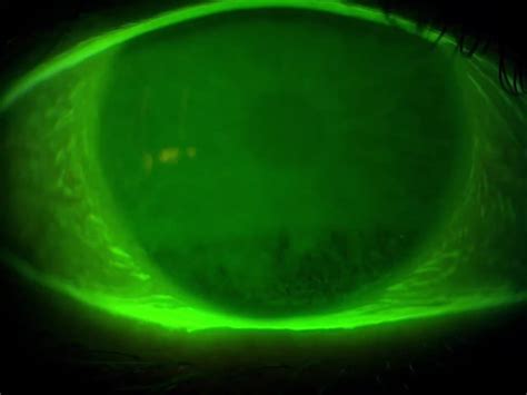 [video] keyur patel on linkedin optomegeek instagram tkseyecare optometrist