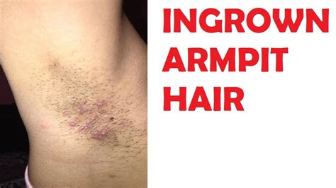 How To Get Rid Of Ingrown Armpit Hair Fast And Simple Youtube