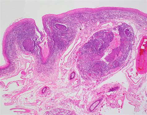 Pathology Outlines Lingual Tonsil