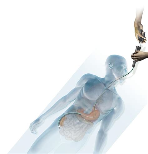 Laparoscopic Appendicectomy Artwork Photograph By Claus Lunau Pixels