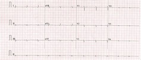 Electrocardiogram Showed A Normal Sinus Rhythm 66 Beats Per Minute
