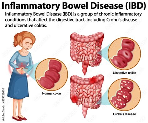 Inflammatory Bowel Disease Ibd Infographic Stock Vector Adobe Stock