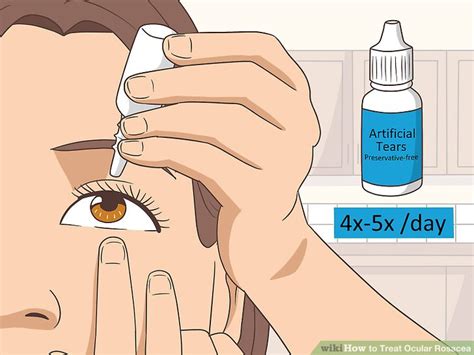 How To Treat Ocular Rosacea Steps With Pictures WikiHow