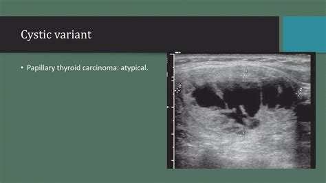 Imaging Of Thyroid PPTX