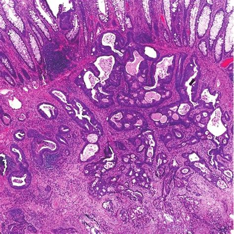 A Malignant Polyp In A Well Oriented Specimen Showing Irregular