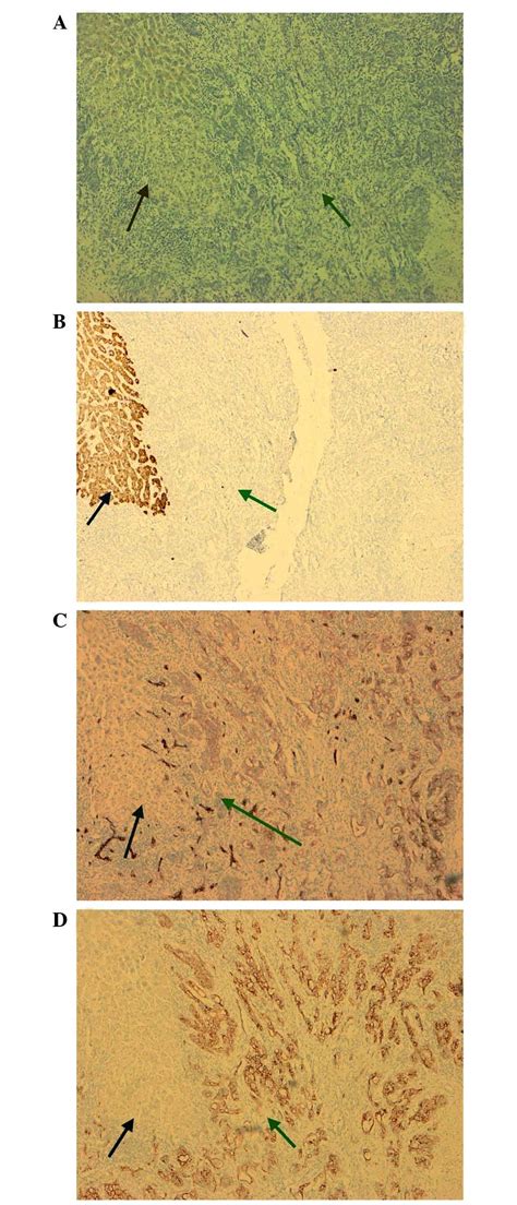 Double Primary Hepatic Cancer Hepatocellular Carcinoma And Intrahepatic Cholangiocarcinoma In