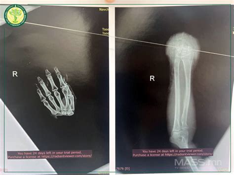 ГССҮТ ийн эмч нар бүрэн тасарсан мөчийг эргүүлэн залгах 200 дахь мэс заслаа амжилттай хийлээ