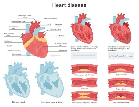 심장 질환 일러스트레이션 심장 문제 심장 발작과 결함 심장염 심장학 프리미엄 벡터