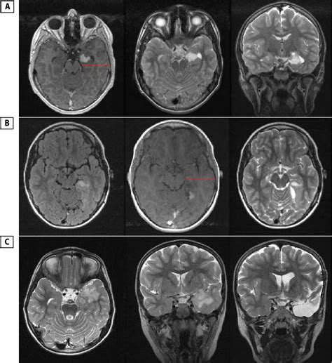 Figure 1 From Middle Temporal Gyrus Approach To Mesial Temporal Lobe