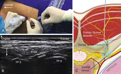 Pain Management For The Cardiac Patient Clinical Tree