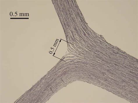 Figure 1 From Modeling The Propagation Of Arterial Dissection
