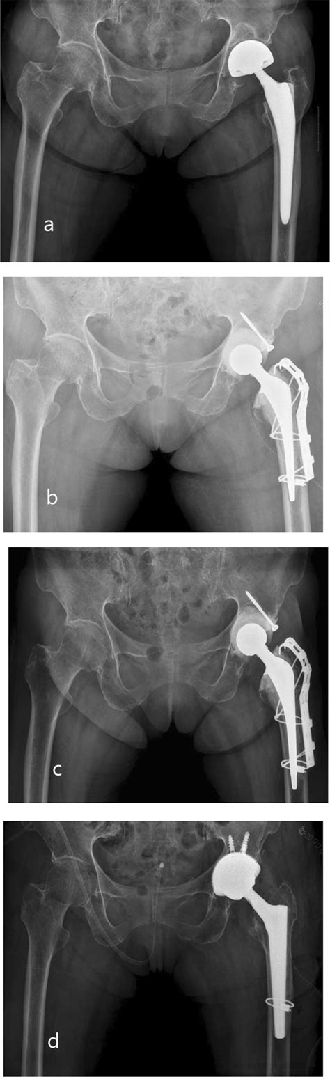 A A 66 Year Old Male Patient Did Prostalac Combined With Screw Fixation Download Scientific