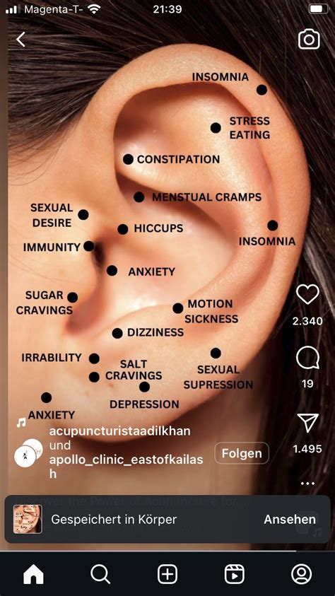 Pin By Carol Song On Ear Acupuncture Acupressure Treatment Ear