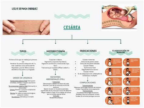 Estado Actual De La Cesárea Cesárea Situación Actual Y Factores
