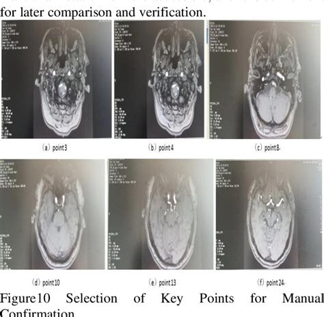 figure 11 from brain mra 3d skeleton extraction based on normal plane