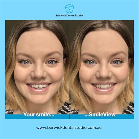 Want To See What Your Future Smile Could Look Like Using The Power Of
