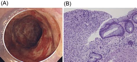 Figure2 Macroscopic And Microscopic Findings Of The Colon Lesion A Download Scientific