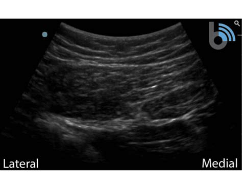 Subgluteal Sciatic Nerve Block Quiz