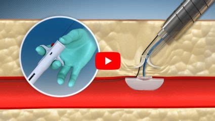 3d Medical And Device Animations Melbourne Australia