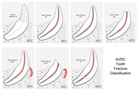 Tooth Fracture Classification