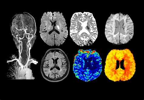 Multiparametric Mri Csi