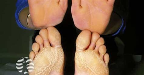 Dermnet® Diffuse Palmoplantar Keratoderma Image