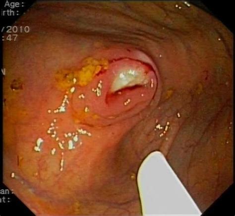 Appendicular Orifice After Resection Of The Polyp Download Scientific Diagram