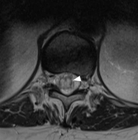 Spinal Dural Arteriovenous Fistula The Missing Piece Sign Ochsner