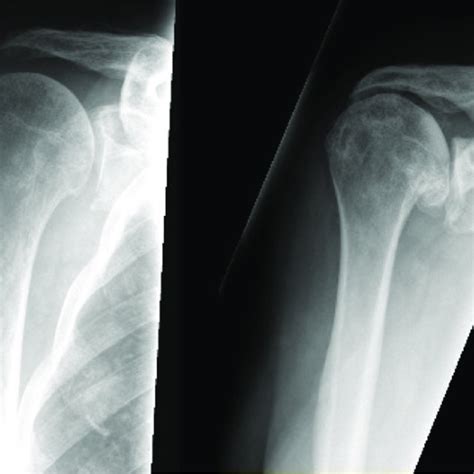 The Types Of Os Acromiale A The Space Between The Os Preacromiale Download Scientific