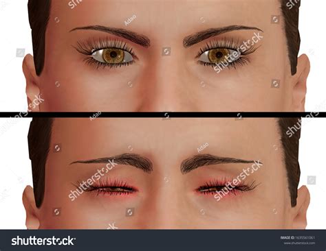 Blepharitis Inflammation Margins Eyelids Symptoms Include ภาพประกอบ