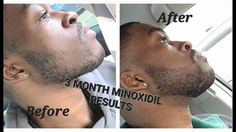 Minoxidil Before And After Beard