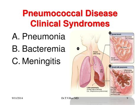 Ppt Streptococcus Pneumoniae Pneumococcus Powerpoint Presentation