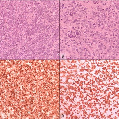 Histopathological Findings A Section Of The Vaginal Lesion Showed