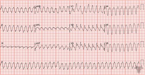 Ventricular Tachycardia Ecg