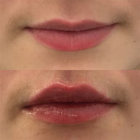 Real Lip Augmentation Results By Dr Devgan — Lara Devgan Md Mph Facs