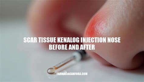 Scar Tissue Kenalog Injection Nose Before And After A Comprehensive Guide
