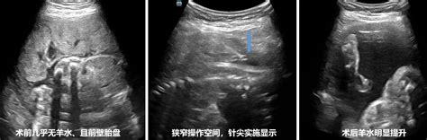 二附院母胎医学mdt团队完成一例高难度超声引导下羊膜腔灌注术 西安交通大学新闻网